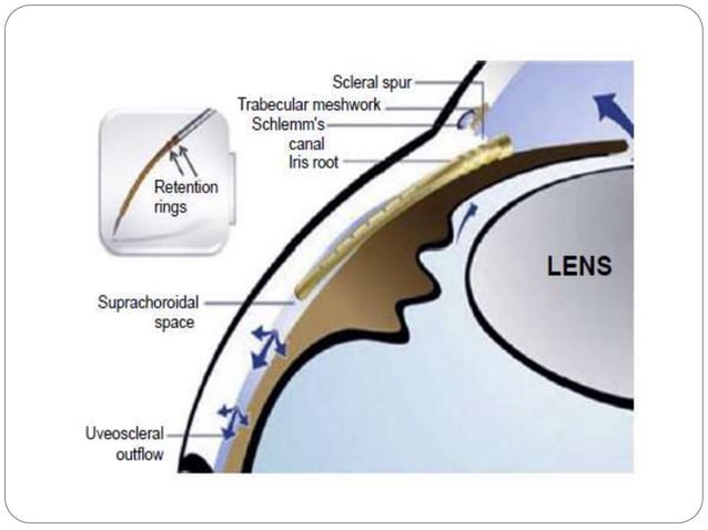 Minimally Invasive Glaucoma Surgery Pptx