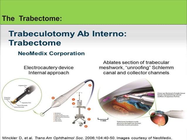 Minimally Invasive Glaucoma Surgery Pptx