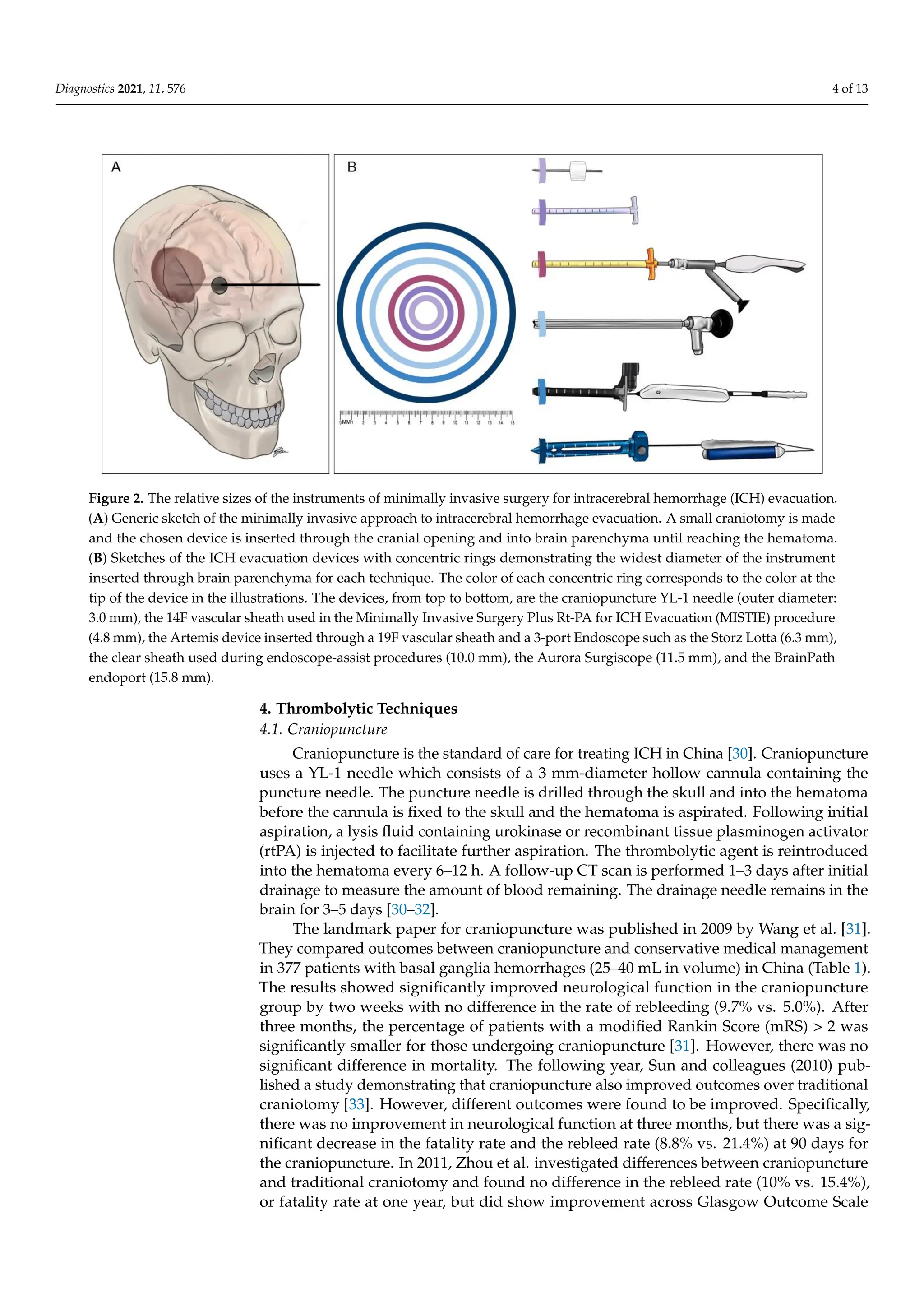 Minimally Invasive Intracerebral Hemorrhage Evacuation.pdf