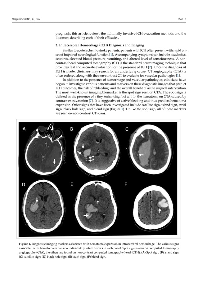 Minimally Invasive Intracerebral Hemorrhage Evacuation.pdf | First Aid | Injuries