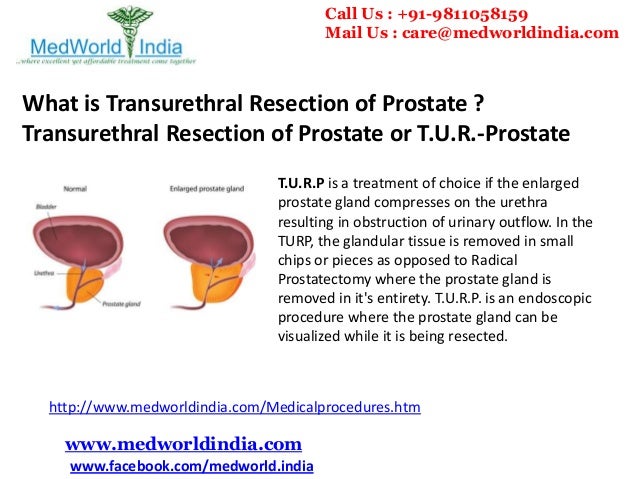 Minimally invasive laser prostate (turp) surgery in india