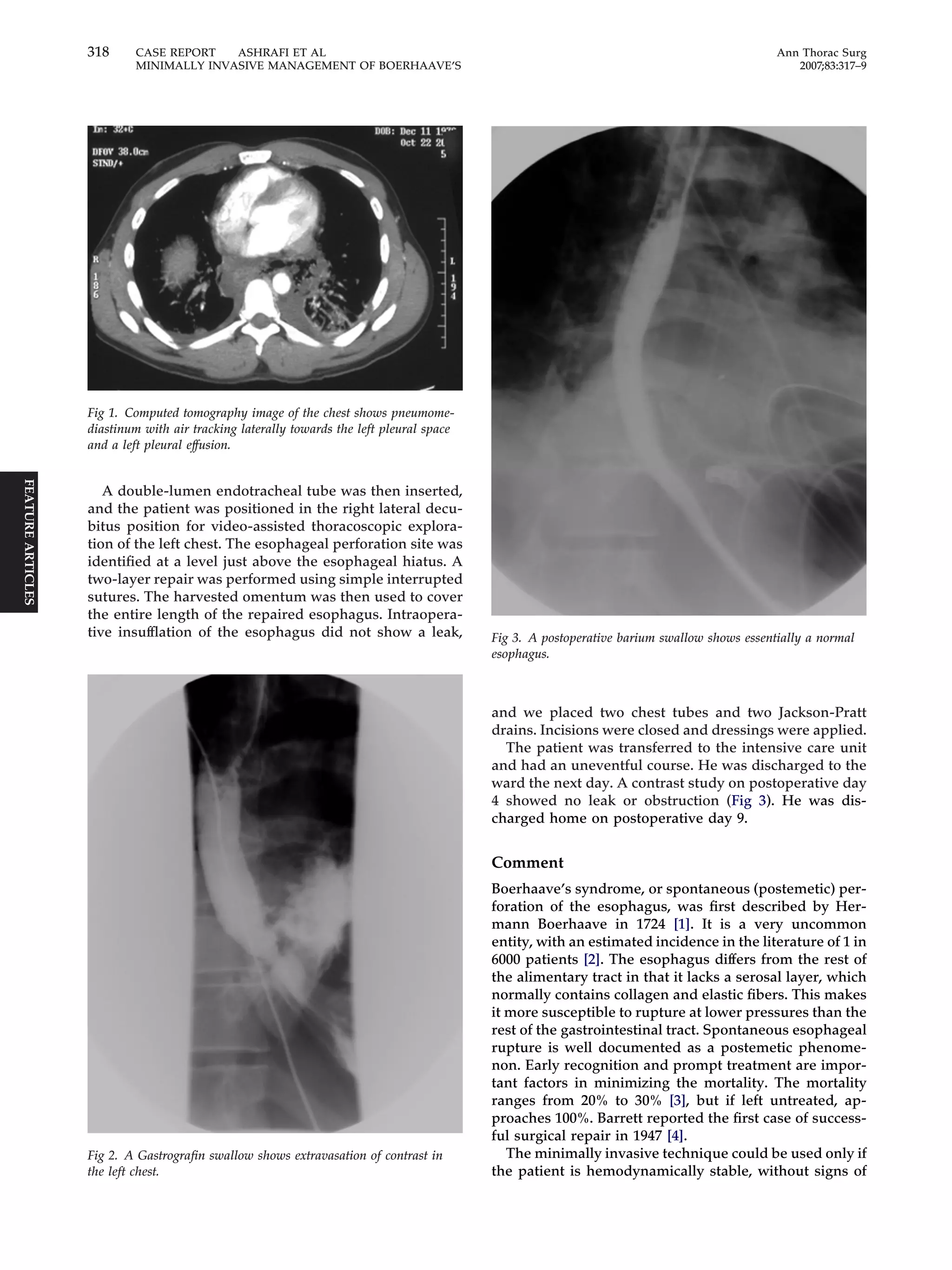 Minimally invasive management of boerhaave´s syndrome | PDF