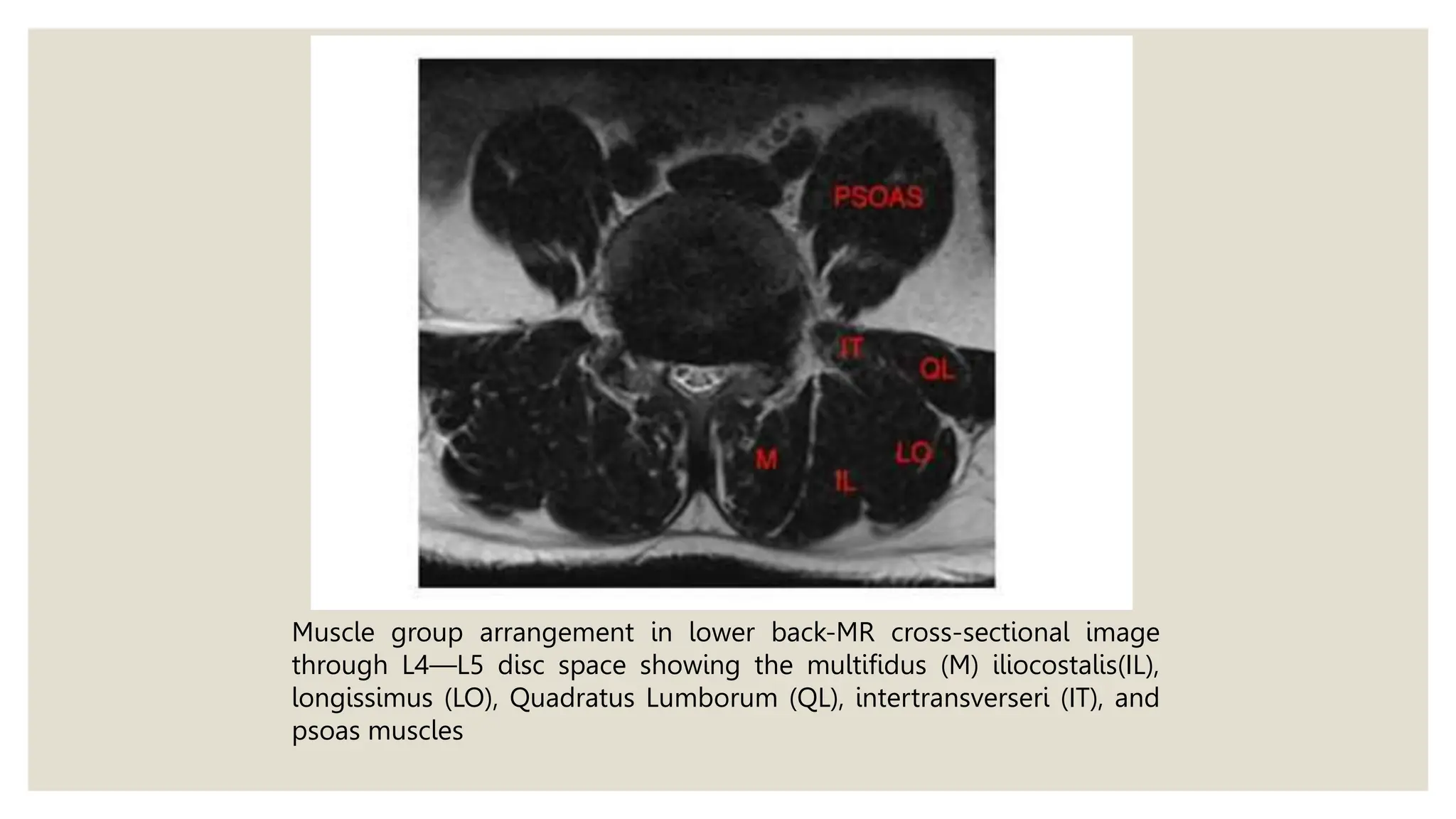 Minimally invasive spine surgery Discussion | PPTX