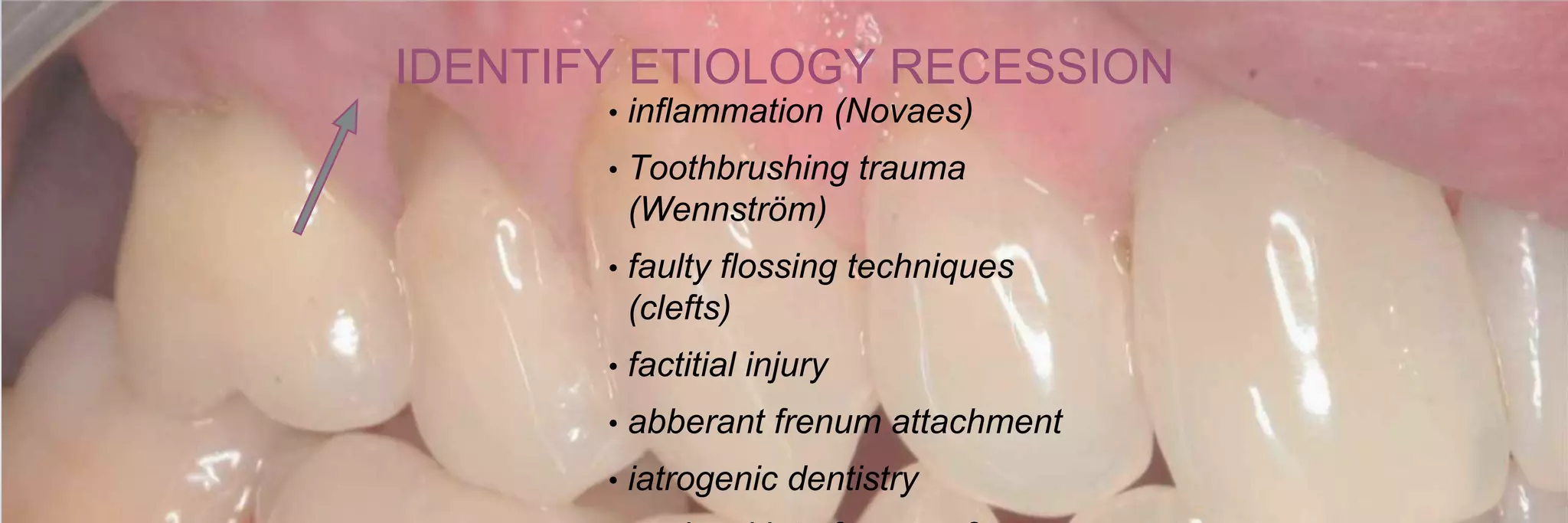 Minimally Invasive Surgery & Acellular Dermal Matrix to Correct ...