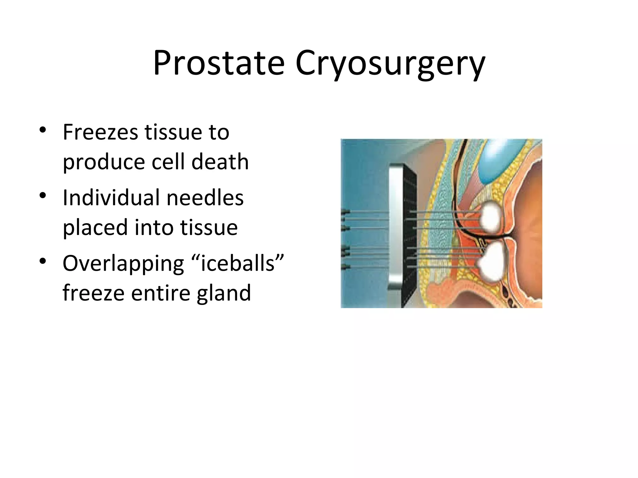 Minimally Invasive Treatment Options for Clinically Localized Prostate ...
