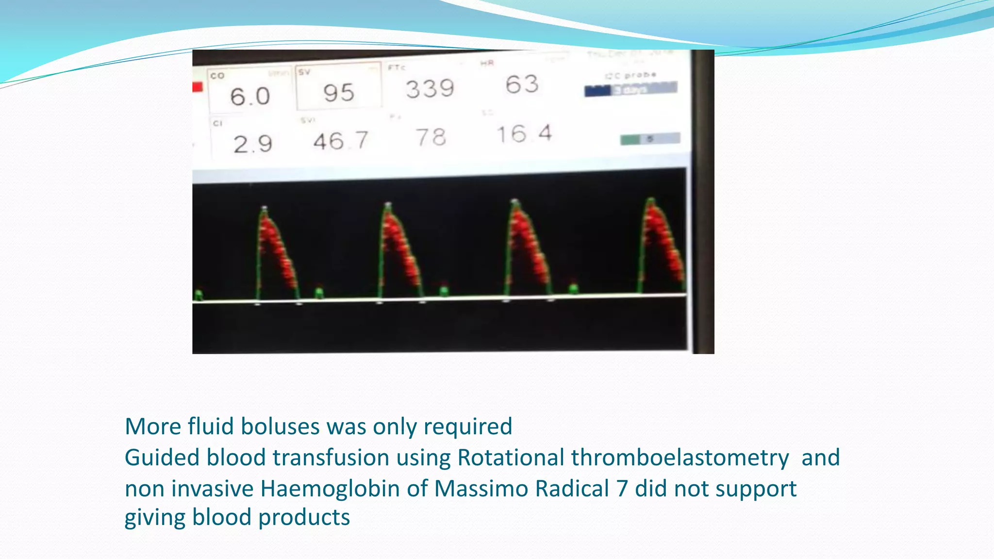 Minimaly invasive hemodynamic monitoring for hepatic patients | PDF