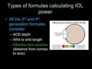 Minimizing wrong iol calculation | PPSX