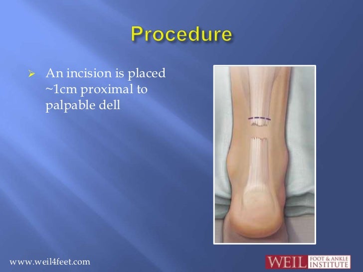 Retrospective analysis on mini-open technique for Achilles tendon rep…