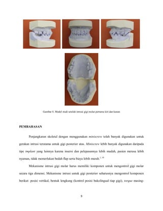 Miniscrew Implant Anchorage for Intrusion Upper First Molar (Case ...