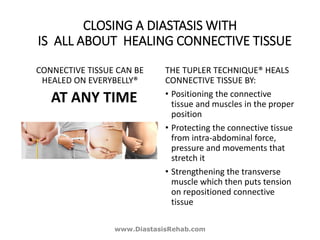 Diastasis Recti: A medical condition with a fitness solution | PDF