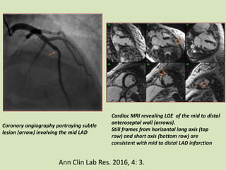 MINOCA , Myocardial Infarction with Non-Obstructive Coronary Arteries ...
