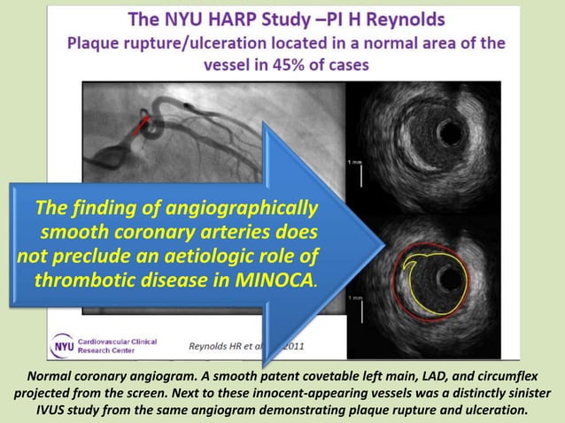 MINOCA , Myocardial Infarction with Non-Obstructive Coronary Arteries ...