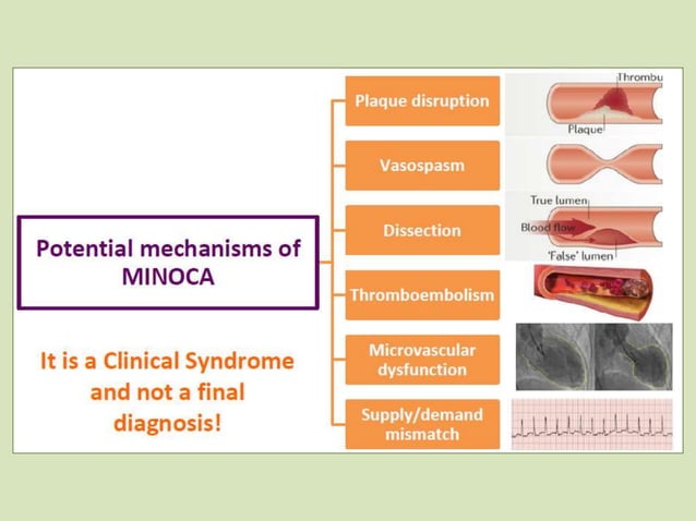 MINOCA , Myocardial Infarction with Non-Obstructive Coronary Arteries