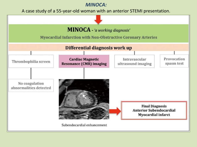 MINOCA , Myocardial Infarction with Non-Obstructive Coronary Arteries