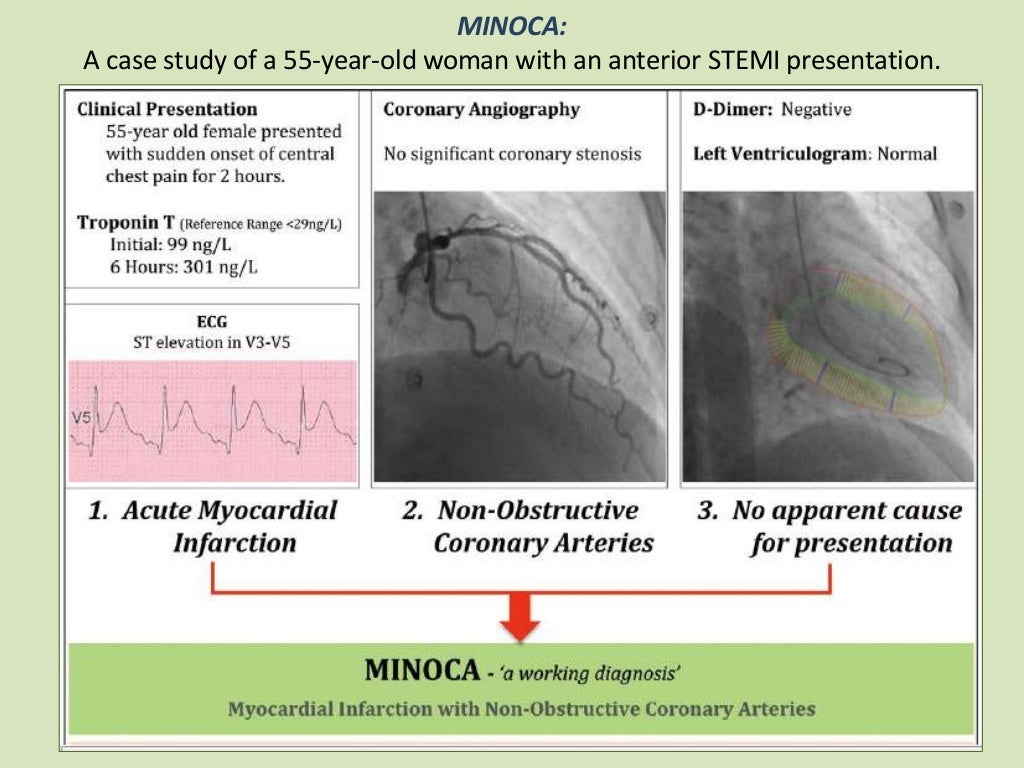 MINOCA , Myocardial Infarction vwith Non-Obstructive Coronary Arteri…