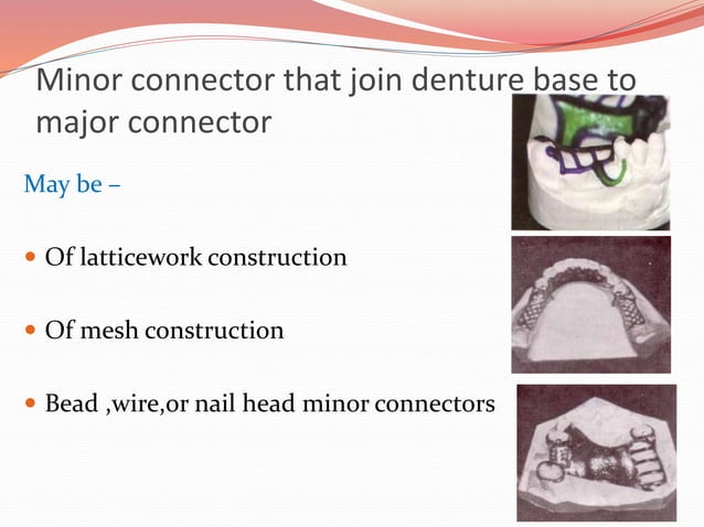 Minor connectors | PPTX | Dental Health | Diseases and Conditions