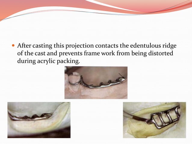 Minor connectors | PPTX | Dental Health | Diseases and Conditions