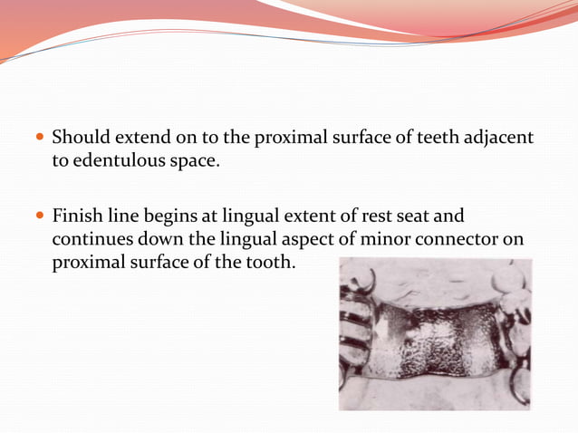 Minor connectors | PPTX | Dental Health | Diseases and Conditions