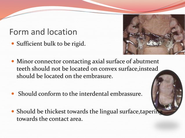 Minor connectors | PPTX | Dental Health | Diseases and Conditions