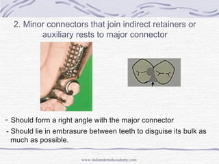 Minor connectors /certified fixed orthodontic courses by Indian dental ...