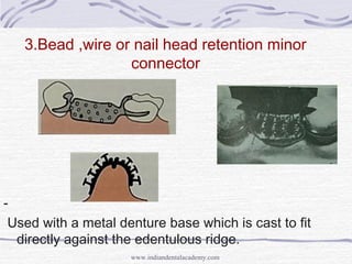 Minor connectors/ dental crown & bridge courses | PPT