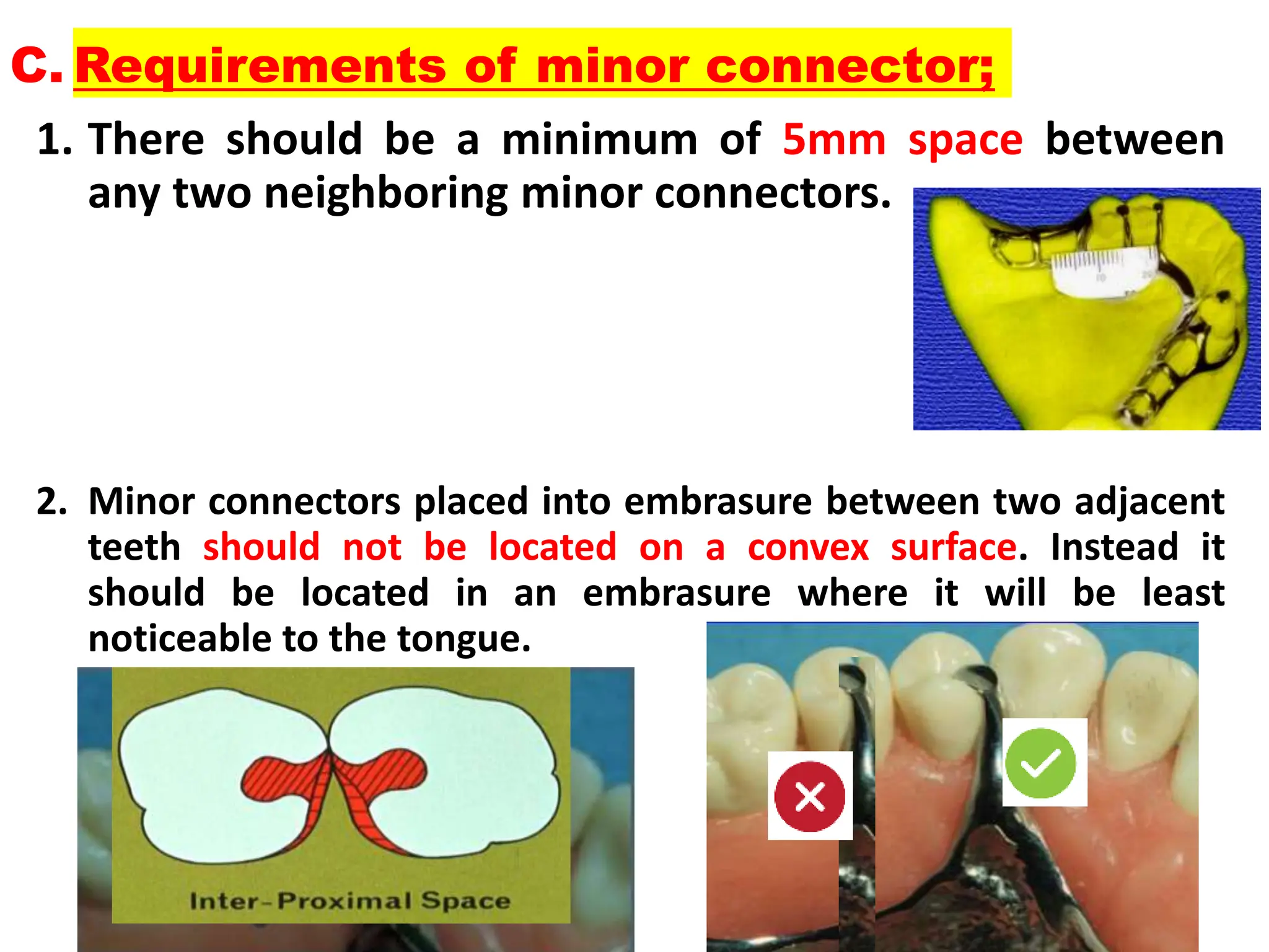 Minor connectors. Preclinical Removable Partial Denture.ppt
