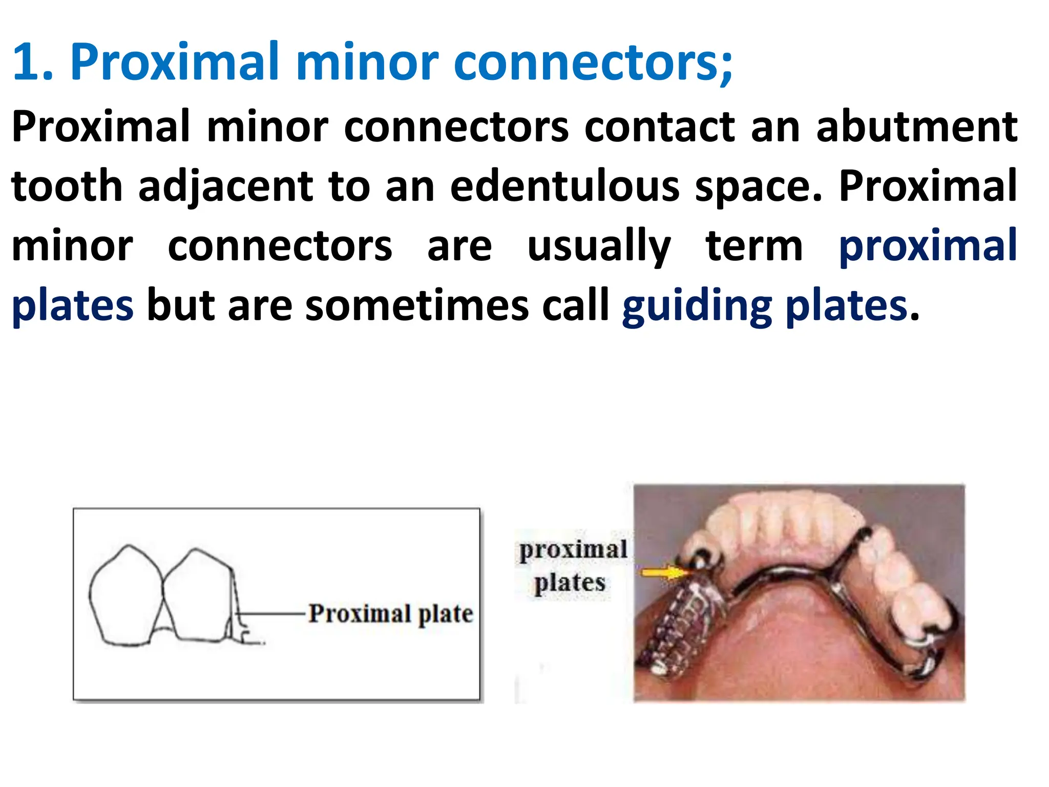 Minor connectors. Preclinical Removable Partial Denture.ppt