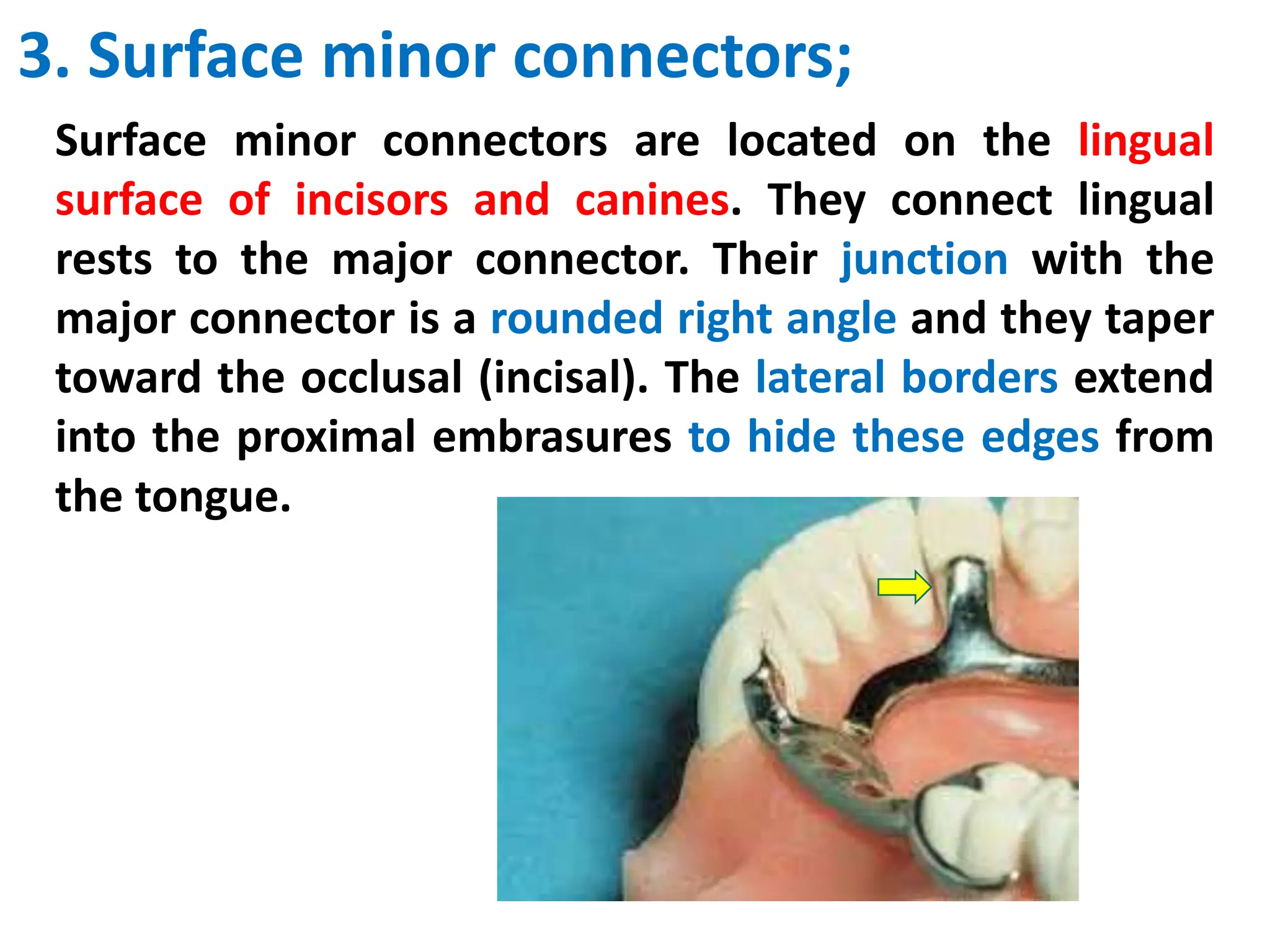 Minor connectors. Preclinical Removable Partial Denture.ppt
