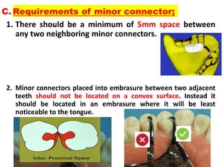 Minor connectors. Preclinical Removable Partial Denture.ppt