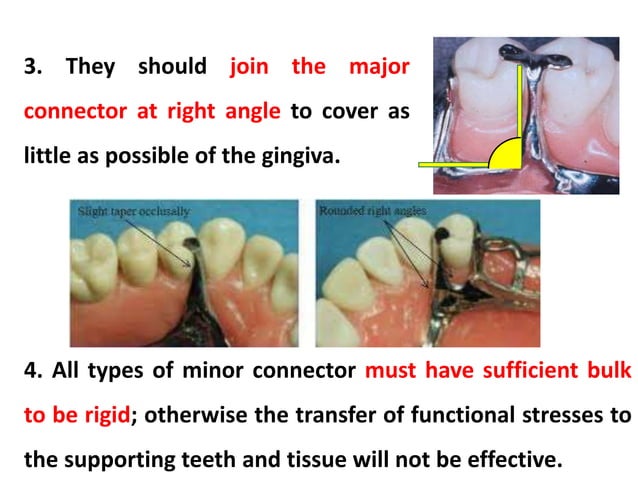 Minor connectors. Preclinical Removable Partial Denture.ppt | Dental ...