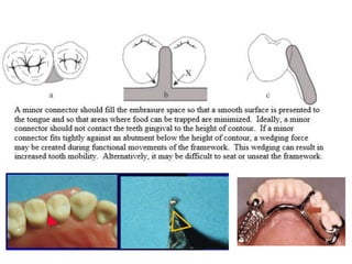 Minor connectors. Preclinical Removable Partial Denture.ppt