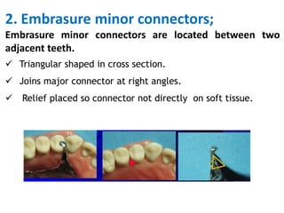 Minor connectors. Preclinical Removable Partial Denture.ppt