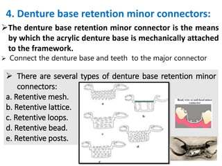 Minor connectors. Preclinical Removable Partial Denture.ppt
