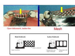 Minor connectors. Preclinical Removable Partial Denture.ppt
