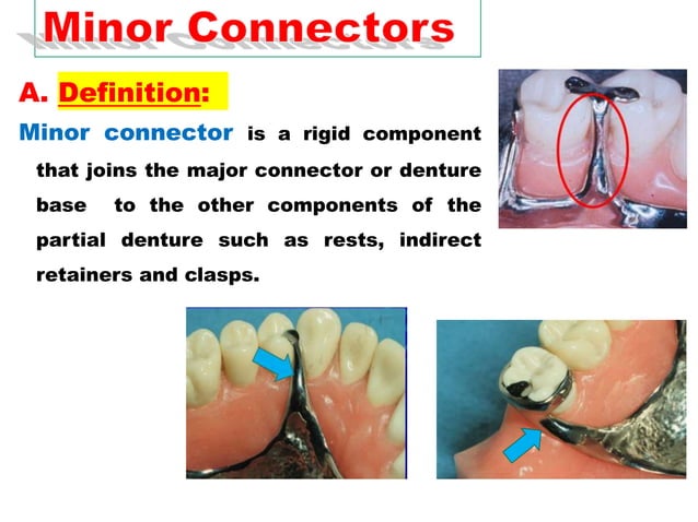 Minor connectors. Preclinical Removable Partial Denture.ppt | Dental ...