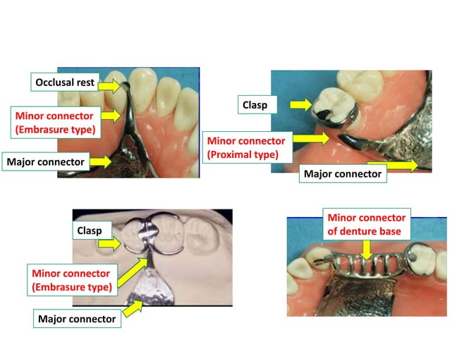 Minor connectors. Preclinical Removable Partial Denture.ppt | Dental ...