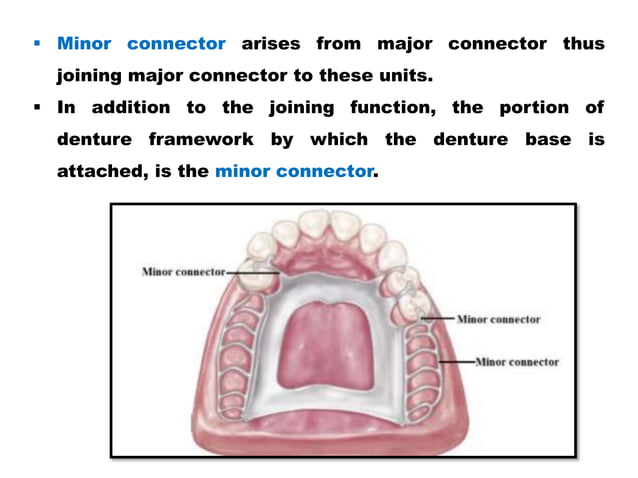 Minor connectors. Preclinical Removable Partial Denture.ppt | Dental ...
