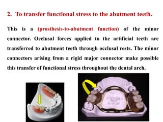 Minor connectors. Preclinical Removable Partial Denture.ppt