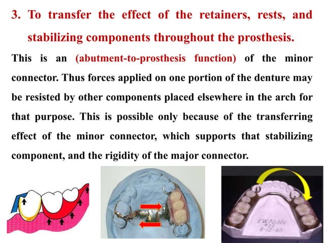 Minor connectors. Preclinical Removable Partial Denture.ppt | Dental ...