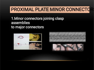 Minor connectors & rests in removable partial denture | PDF