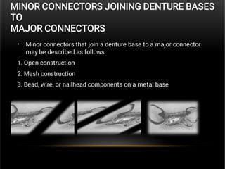 Minor connectors & rests in removable partial denture | PDF
