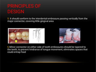 Minor connectors & rests in removable partial denture | PDF