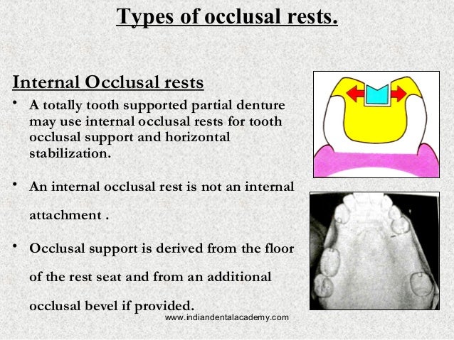 Minor connectors & rests & rest seats /certified fixed orthodontic co…
