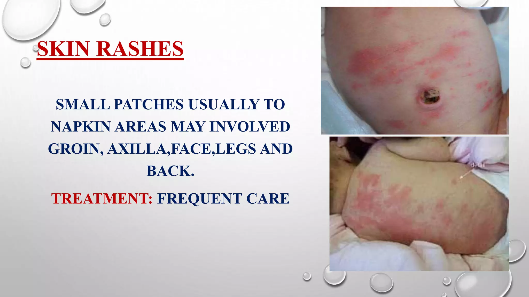 Minor disorders of newborn | PPTX