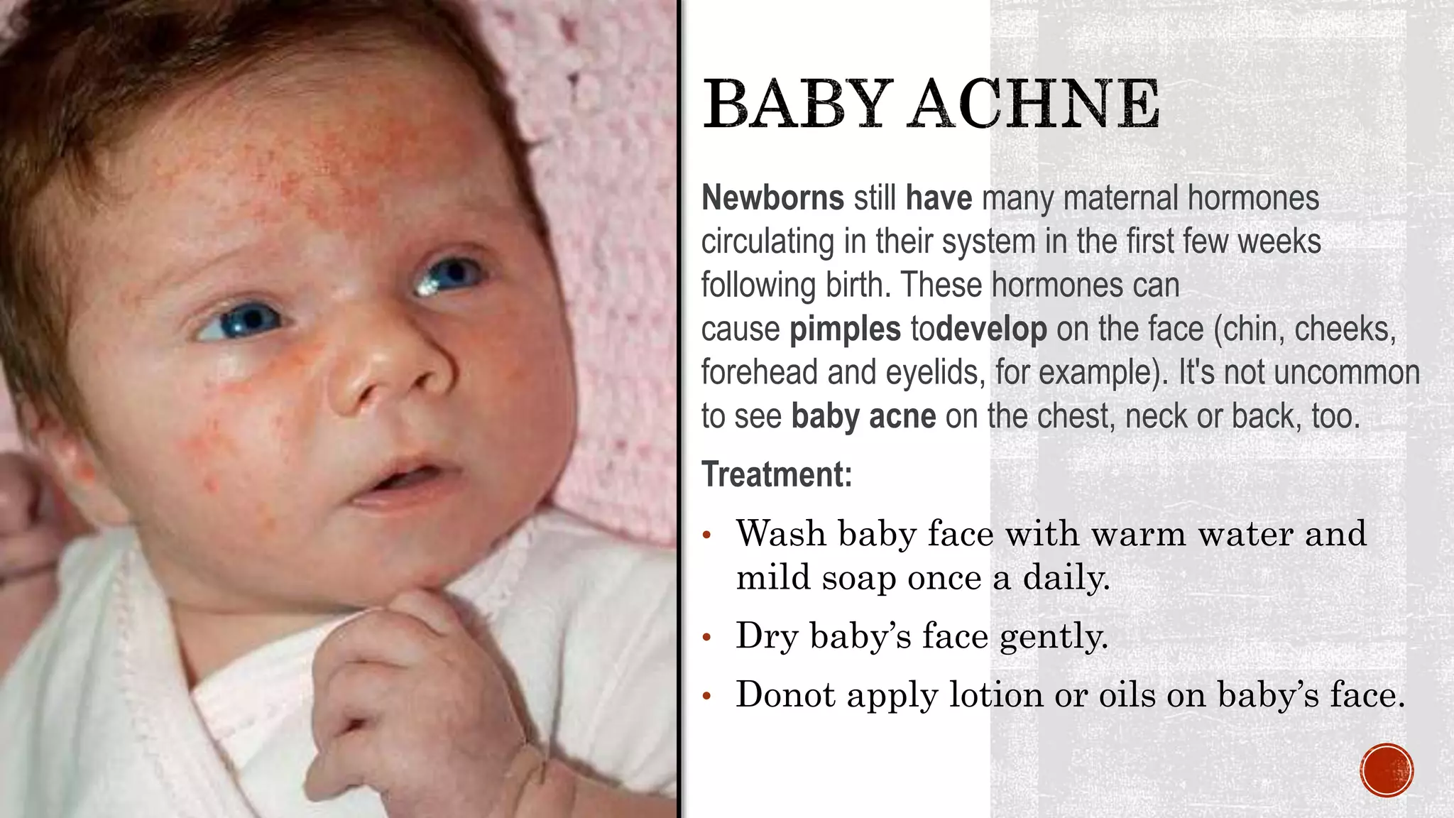 Minor disorders of newborn 1 | PPTX