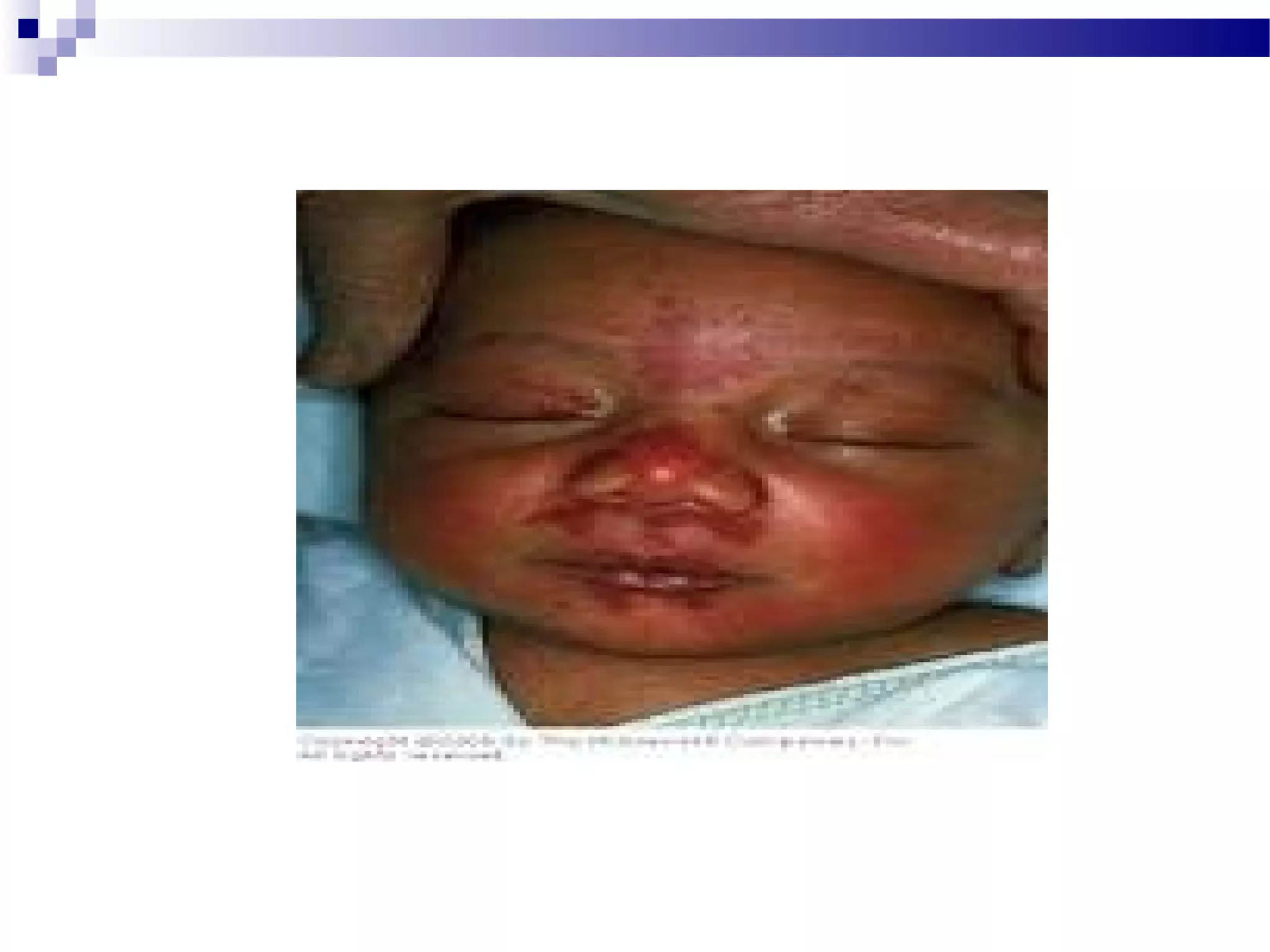 Minor Disorders Of Newborn Ppt