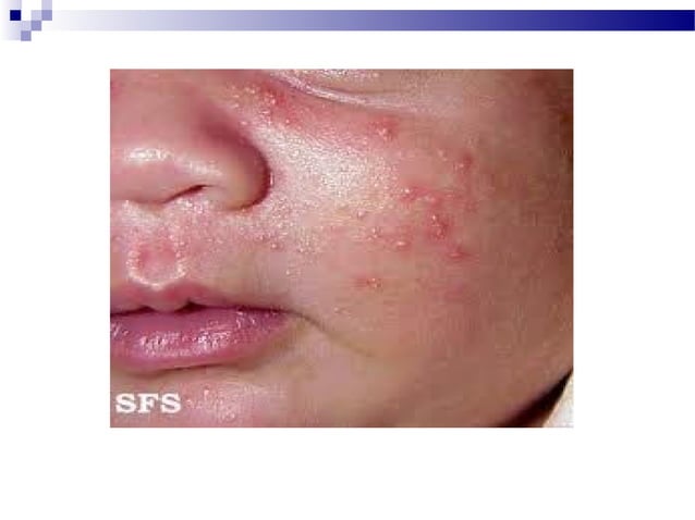 Minor Disorders Of Newborn