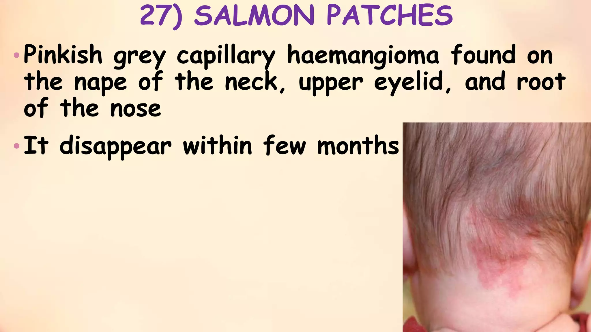 minor disorders of neonates and its management - shani -ppt- slideshare ...