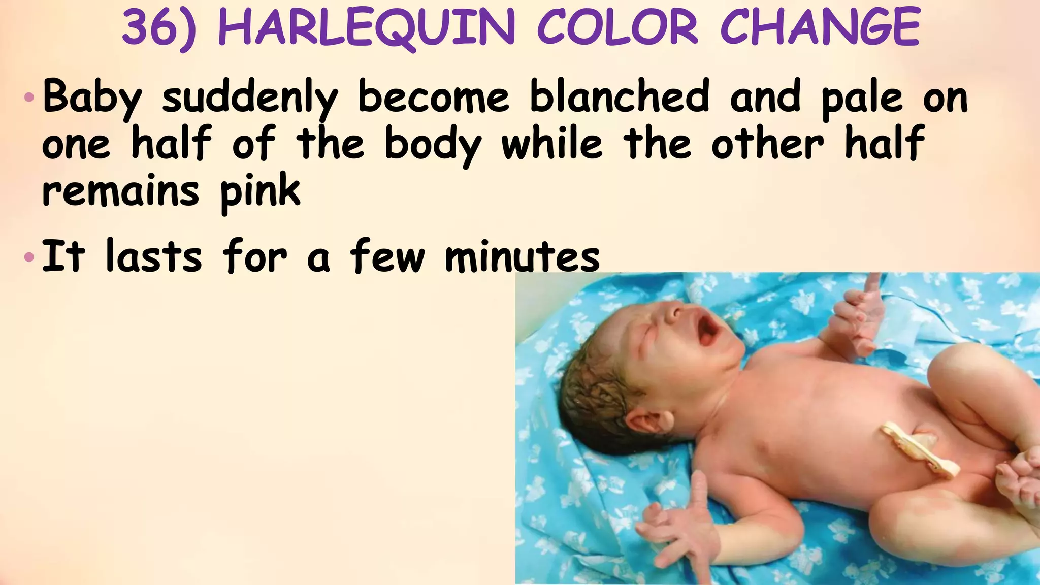 minor disorders of neonates and its management - shani -ppt- slideshare ...