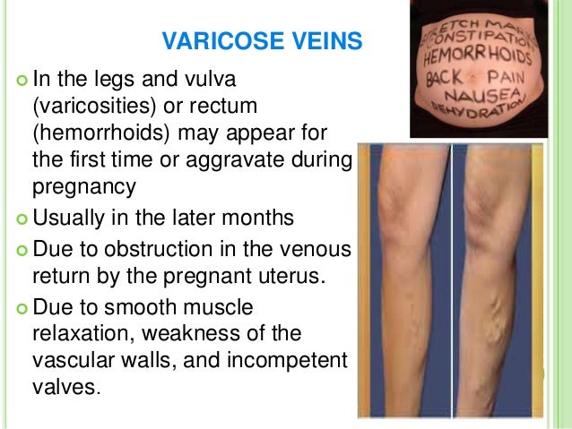 Vulvar Varicose Veins And Pregnancy: Childbirth Management – BUBQV